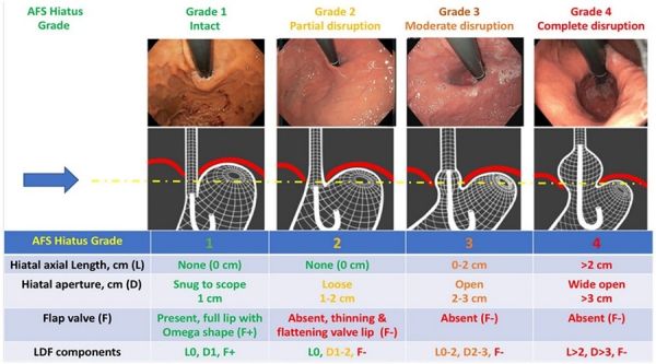 American Foregut Society Recommends Improved Classification System to ...